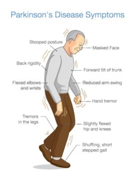 Causes and Symptoms of Parkinsons disease - V Cure