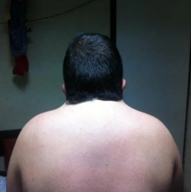 How to Manage Klippel-Feil Syndrome- A Neck Fusion Disorder - V Cure